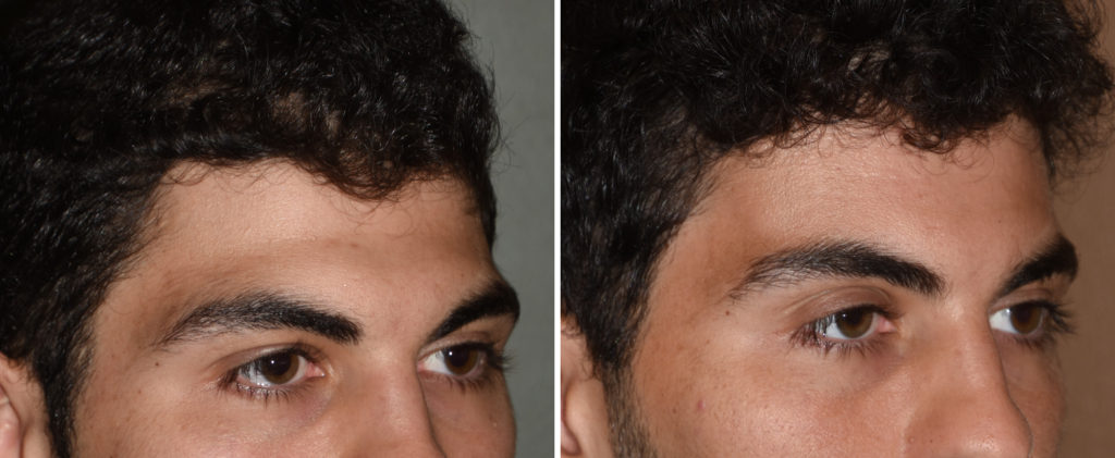 Forehead Augmentation result oblique view Dr Barry Eppley Indianapolis ...