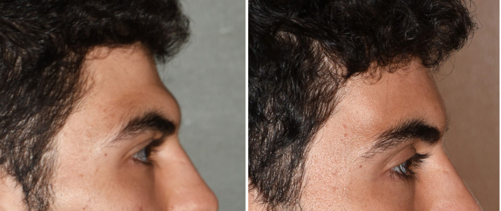 Forehead Augmentation result side view Dr Barry Eppley Indianapolis ...