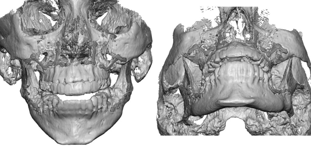 Plastic Surgery Case Study - Custom Jaw Angle Implants for Sagittal ...