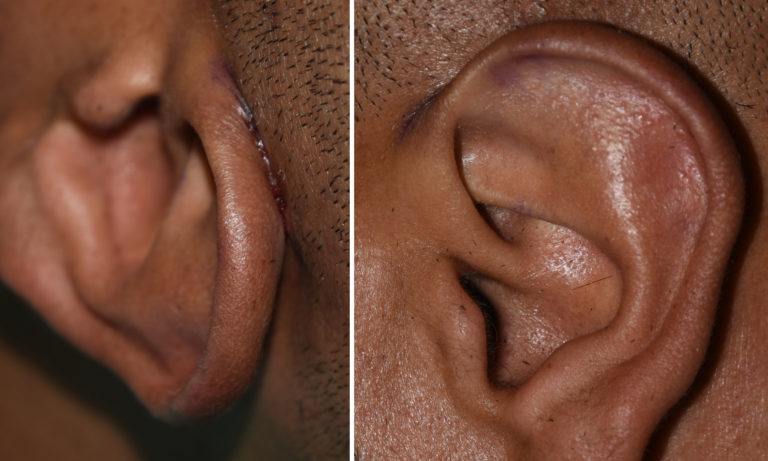 Postauricular Sulcus Reduction for Maximal Correction of the Upper ...