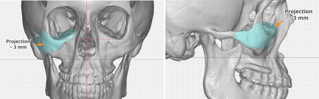 Plastic Surgery Case Study - Custom Orbital Floor- Rim-Malar Implant in ...