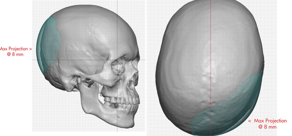 Plastic Surgery Case Study - Right Occipital Plagiocephaly Custom Skull ...