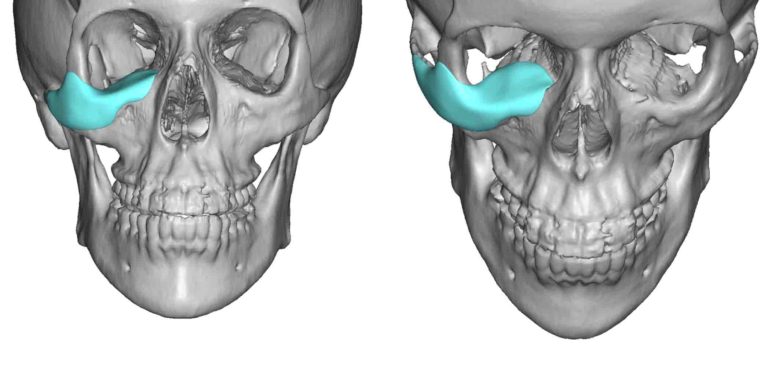 Plastic Surgery Case Study - Custom Orbital Floor- Rim-Malar Implant in ...