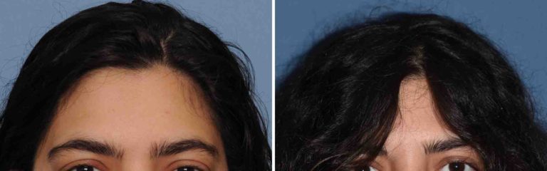 Skull Reduction results front view Dr Barry Eppley Indianapolis ...