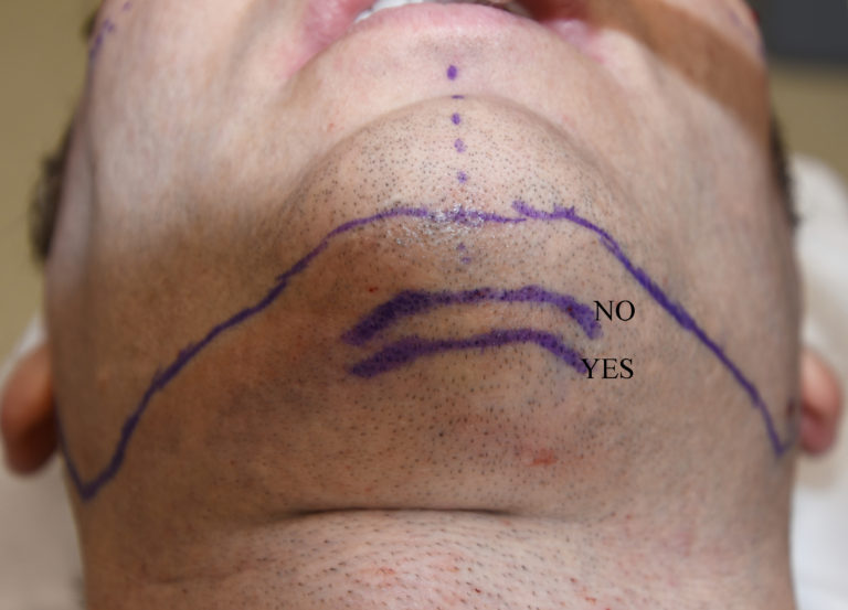 The Submental Incision in Custom Jawline Implants - Explore Plastic Surgery