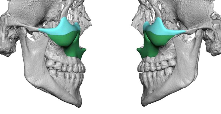 Two-Piece Custom Midface Implants Design for Total Aesthetic Midface ...