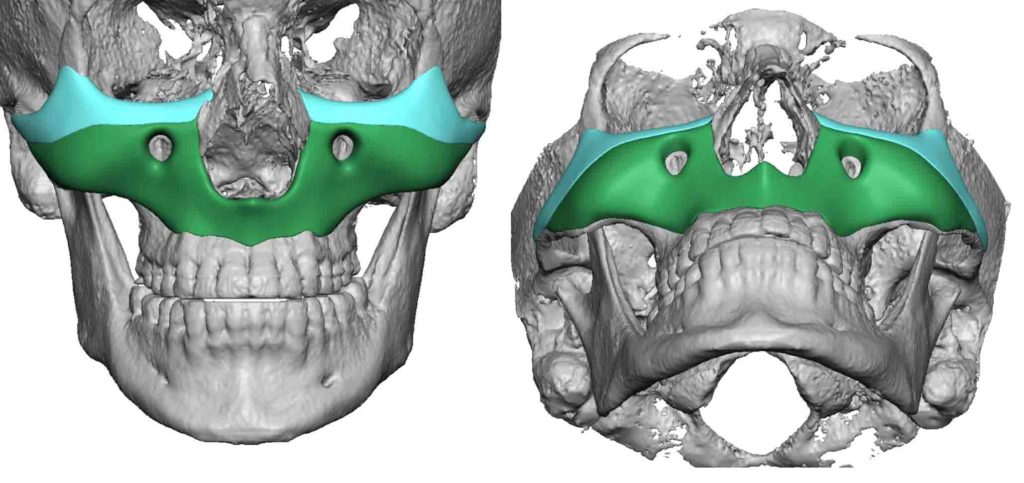Two-Piece Custom Midface Implants Design for Total Aesthetic Midface ...