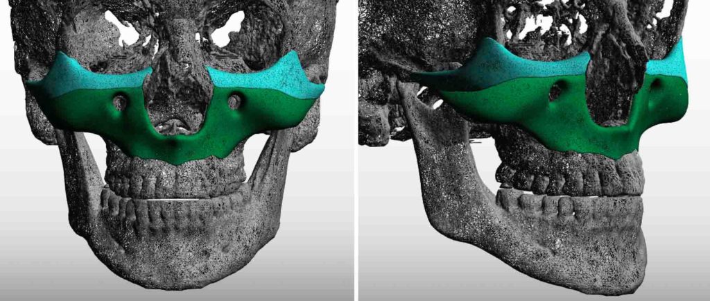 Two-Piece Custom Midface Implants Design for Total Aesthetic Midface ...