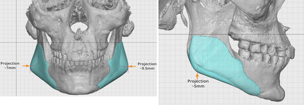 Plastic Surgery Case Study - Custom Jaw Angle Implants after Sagittal ...