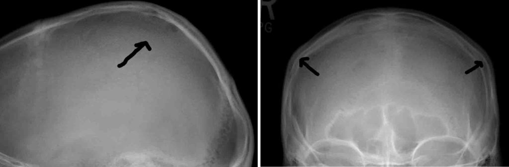 OR Snapshots - Parietal Eminence Skull Reduction - Explore Plastic Surgery