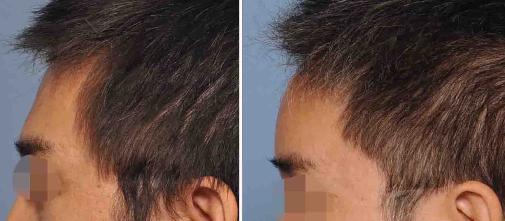 Plastic Surgery Case Study - Asian Male Bone Cement Forehead ...