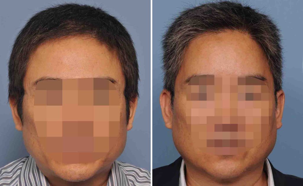 Asian Skull Reshaping result front view Dr Barry Eppley Indianapolis ...