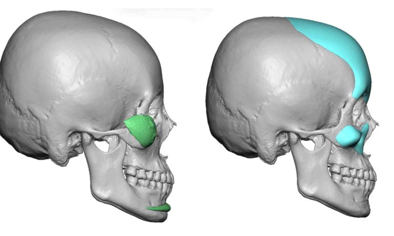Custom Forehead and Cheek Implants for Facial Projection 3D images side ...