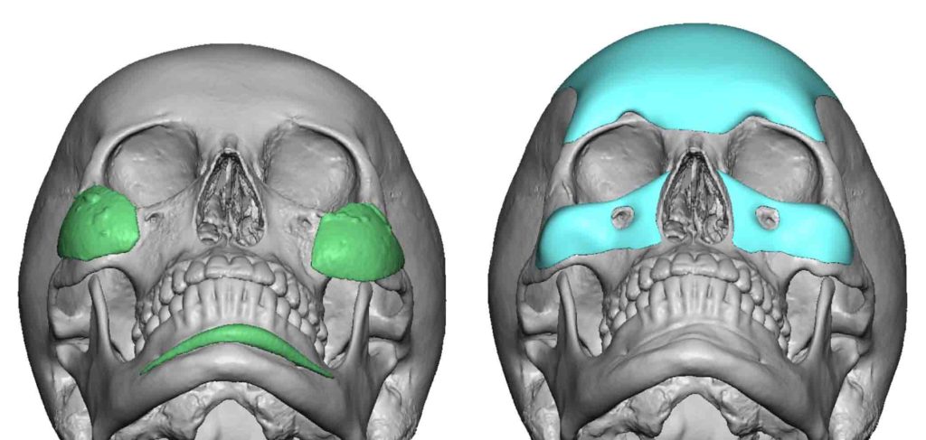 Custom Forehead and Cheek Implants for Increased Facial Projection ...