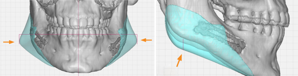 Plastic Surgery Case Study - Custom Jaw Angle Implants after Sagittal ...