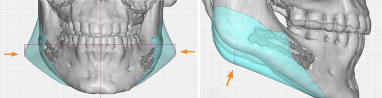 Custom Jaw Angle Implant Reconstruction of Jaw Angles design Dr Barry ...