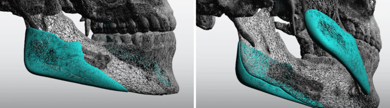 Plastic Surgery Case Study - Custom Jaw Angle Implants after Sagittal ...