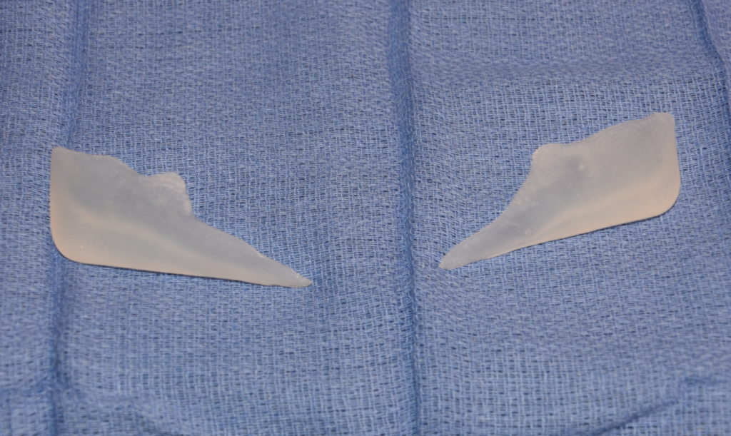 Custom Jaw Angle Implants after Sagittal Split Mandibular Osteotomies ...