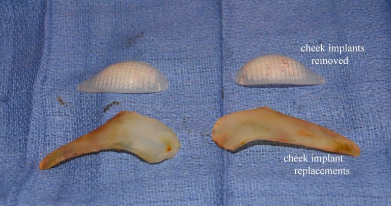 Plastic Surgery Case Study - Extended Cheek Implants for the Model ...