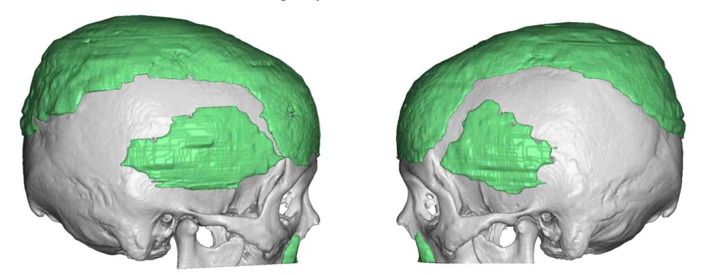 PMMA Bone Cement Total Cranioplasty result side view Dr Barry Eppley ...