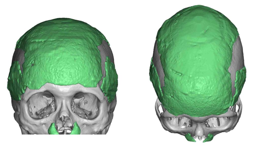 Plastic Surgery Case Study - Secondary Skull Augmentation using a 3D ...
