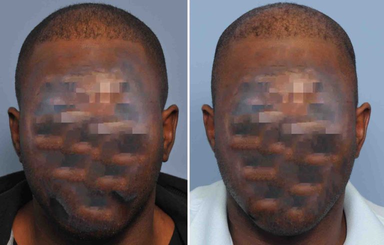 Plastic Surgery Case Study - Posterior Temporal Reduction for Reducing ...