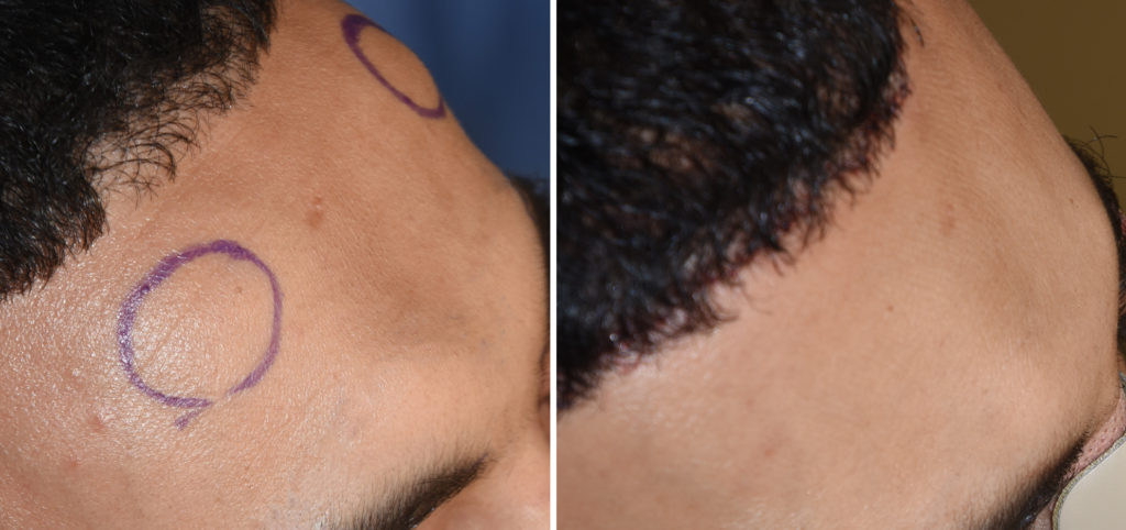 Plastic Surgery Case Study - Male Forehead Horn Removal - Explore ...