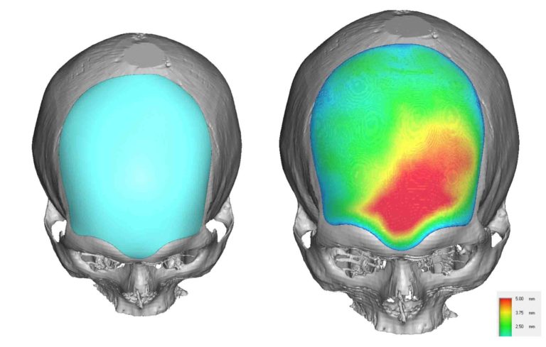 Plastic Surgery Case Study - Custom Forehead Implant To Create A Brow ...