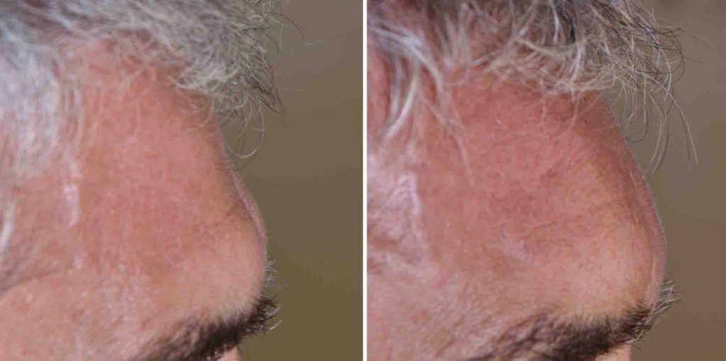 Plastic Surgery Case Study - Custom Forehead Implant To Create A Brow ...