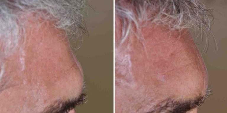 Custom Forehead Implant for Brow Bone Protrusion result intraop Dr ...