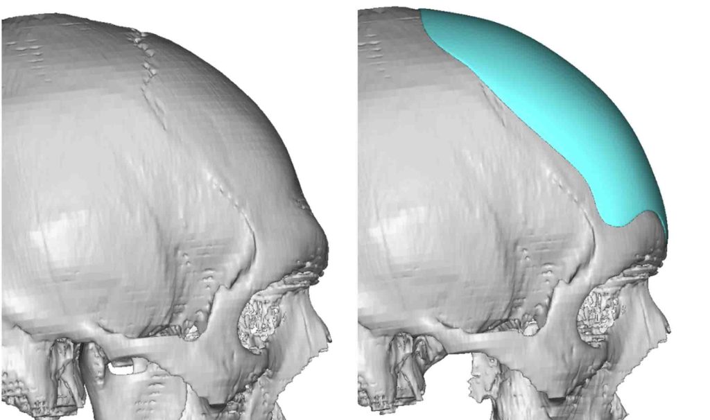 Plastic Surgery Case Study - Custom Forehead Implant To Create A Brow ...