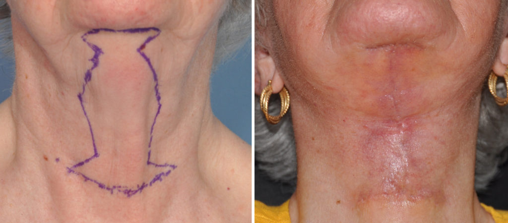 Plastic Surgery Case Study - Direct Necklift for the Female Turkey Neck ...