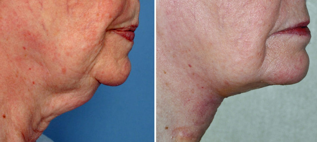 Plastic Surgery Case Study - Direct Necklift for the Female Turkey Neck ...