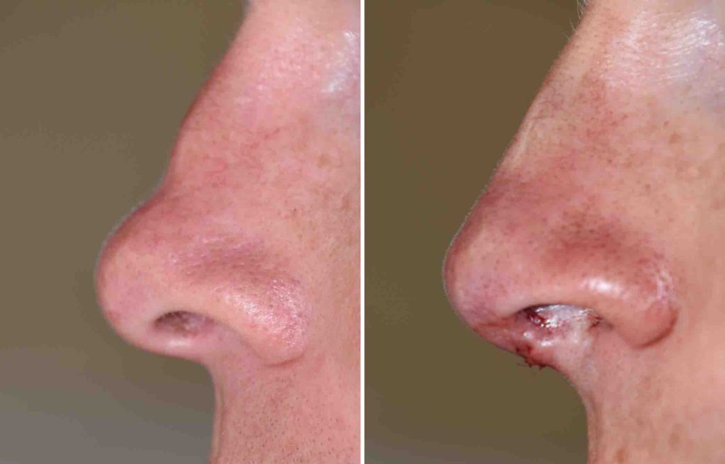 Plastic Surgery Case Study - Rib Graft Rhinoplasty in the Traumatic ...