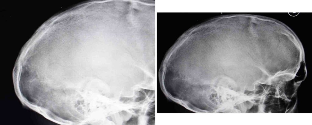 Plastic Surgery Case Study - Occipital Skull Reduction in the Adult ...