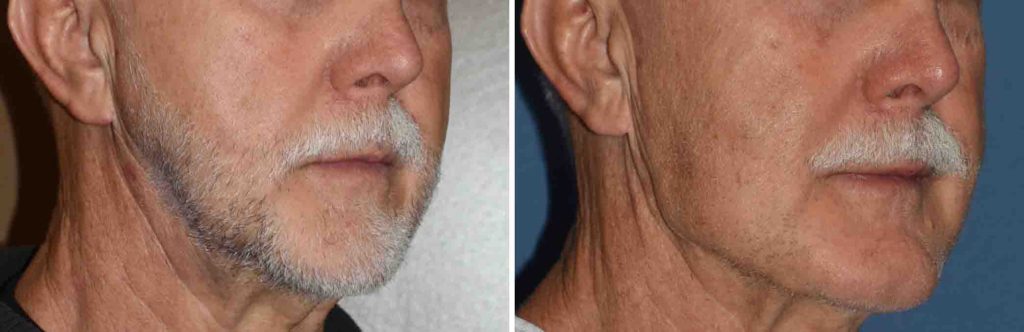 Plastic Surgery Case Study - Custom Jawline Implant for Major Vertical ...