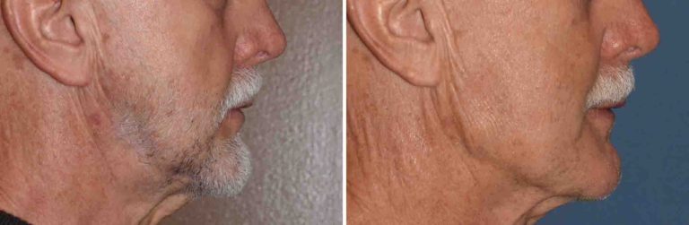 Plastic Surgery Case Study - Custom Jawline Implant for Major Vertical ...