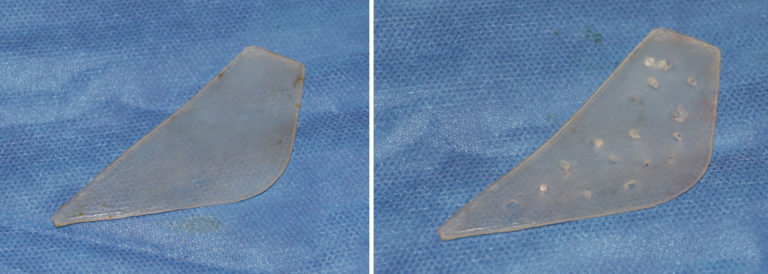 Plastic Surgery Case Study - Soft Tissue Implant for Masseteric Muscle ...