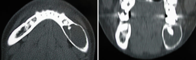 Aneursymal Bone Cyst CT scan left Mandible Dr Barry Eppley Indianapolis ...