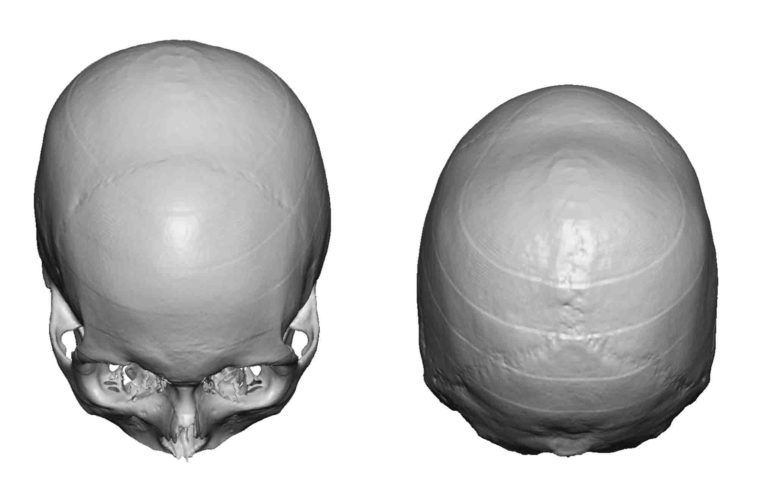 Plastic Surgery Case Study - Custom Skull Implant Correction of a ...