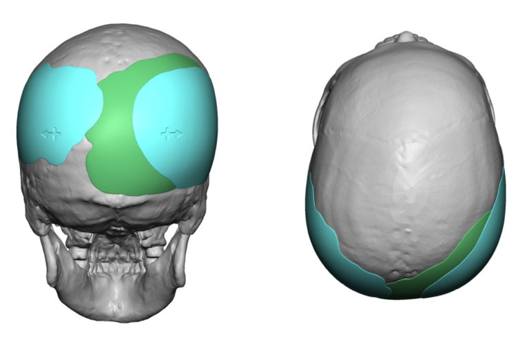 Plastic Surgery Case Study - Secondary Custom Skull Implant Overlays ...