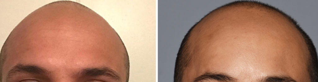 Plastic Surgery Case Study - Correction of the Inverted V Head Shape ...
