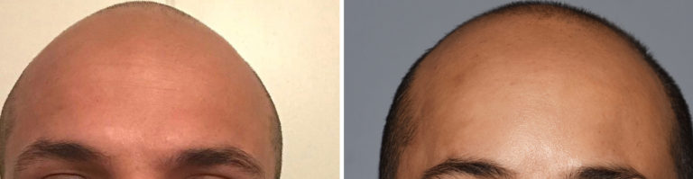 Plastic Surgery Case Study - Correction of the Inverted V Head Shape ...