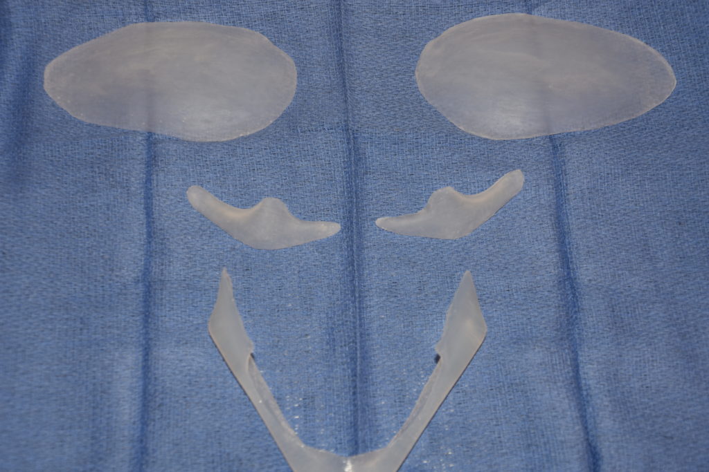 Major Facial Reshaping with Multiple Custom Facial Implants - Explore ...