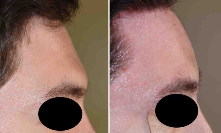 Plastic Surgery Case Study - Male Brow Bone Reduction by Bone Flap ...