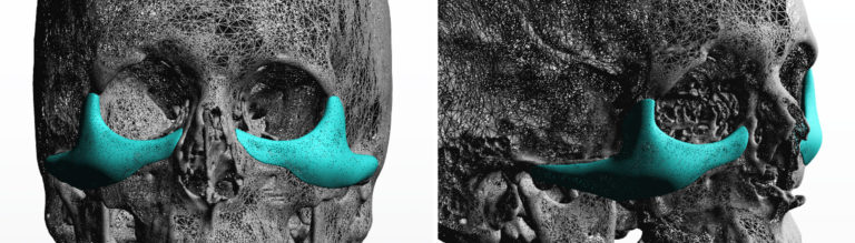 The Incisional Approaches for Custom Infraorbital Rim Implants ...