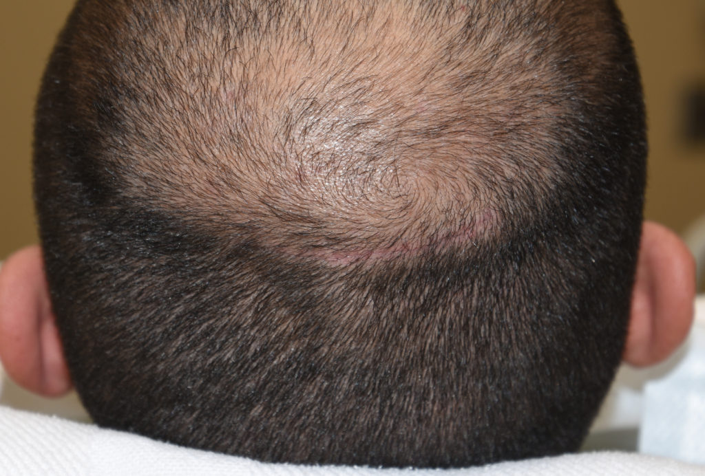 Scalp Incision for Custom Skull Implant placement Dr Barry Eppley ...