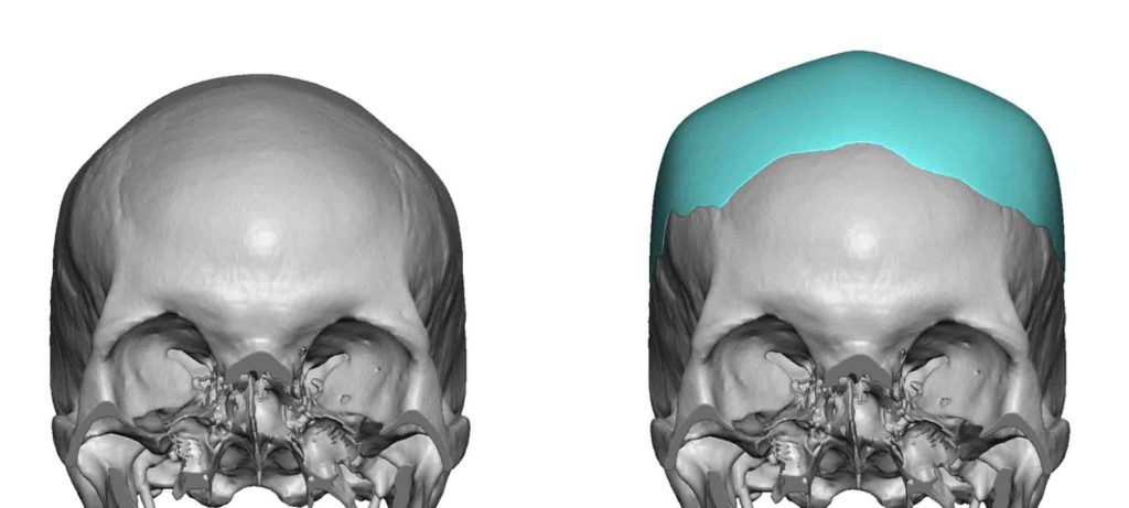Plastic Surgery Case Study - Creating the Model Head Shape with a ...