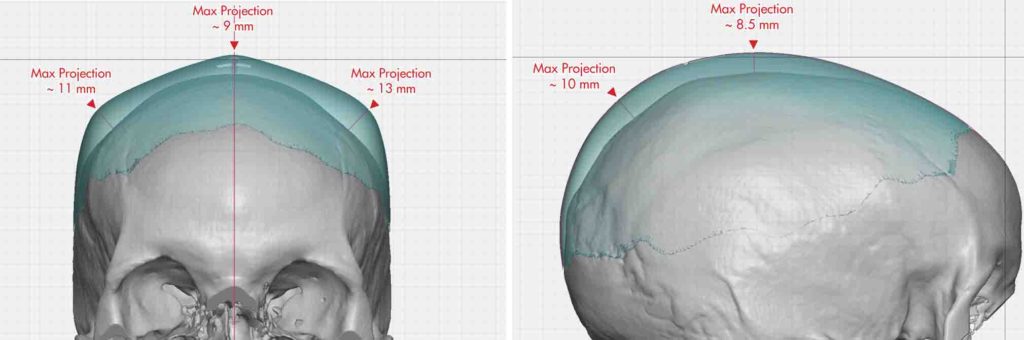 Plastic Surgery Case Study - Creating the Model Head Shape with a ...