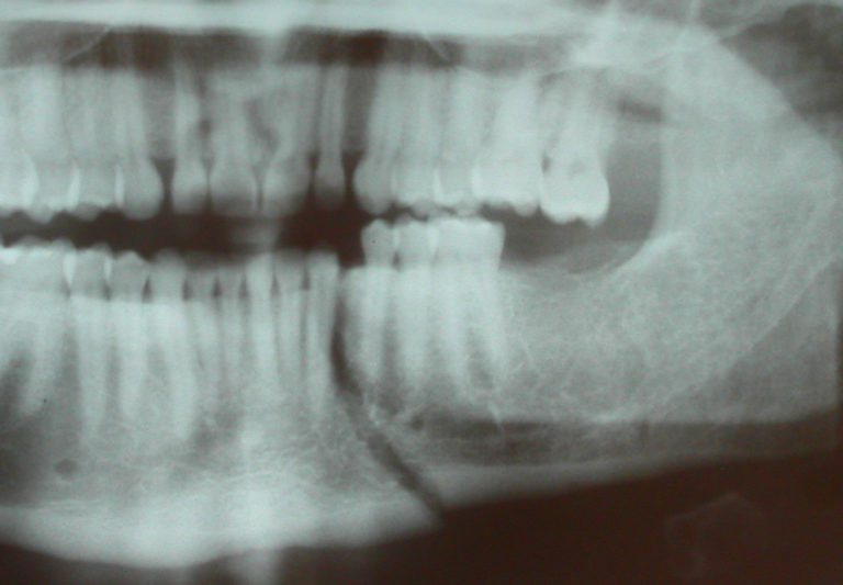 OR Snapshots - Intraoral ORIF of Parasymphyseal Mandibular Fracture ...